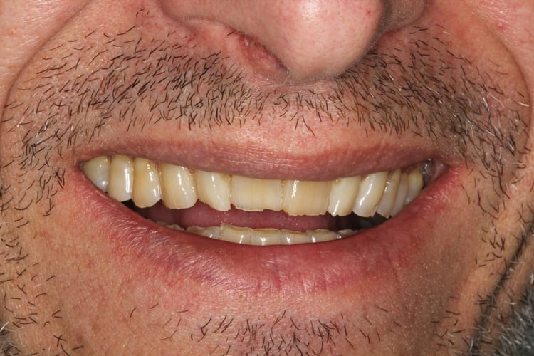 Seamless Incisal Edge Repair Using OMNICHROMA Composite