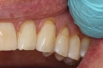 Seamless Incisal Edge Repair Using OMNICHROMA Composite
