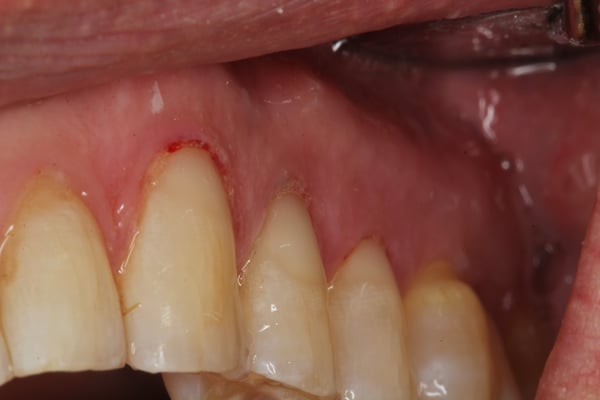 Seamless Incisal Edge Repair Using OMNICHROMA Composite