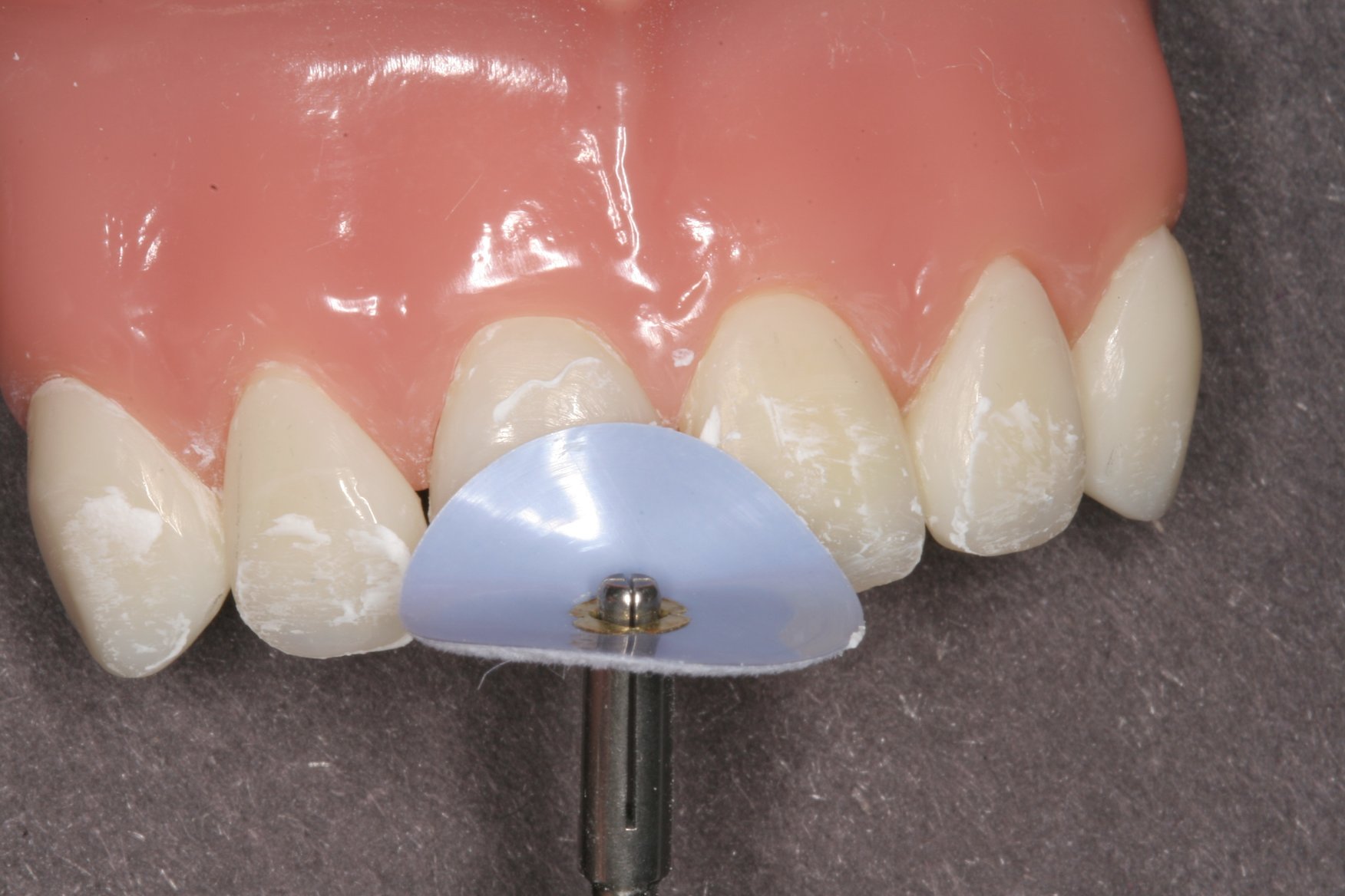 Mastering Anterior Composites: Tips from Dr. Fahl