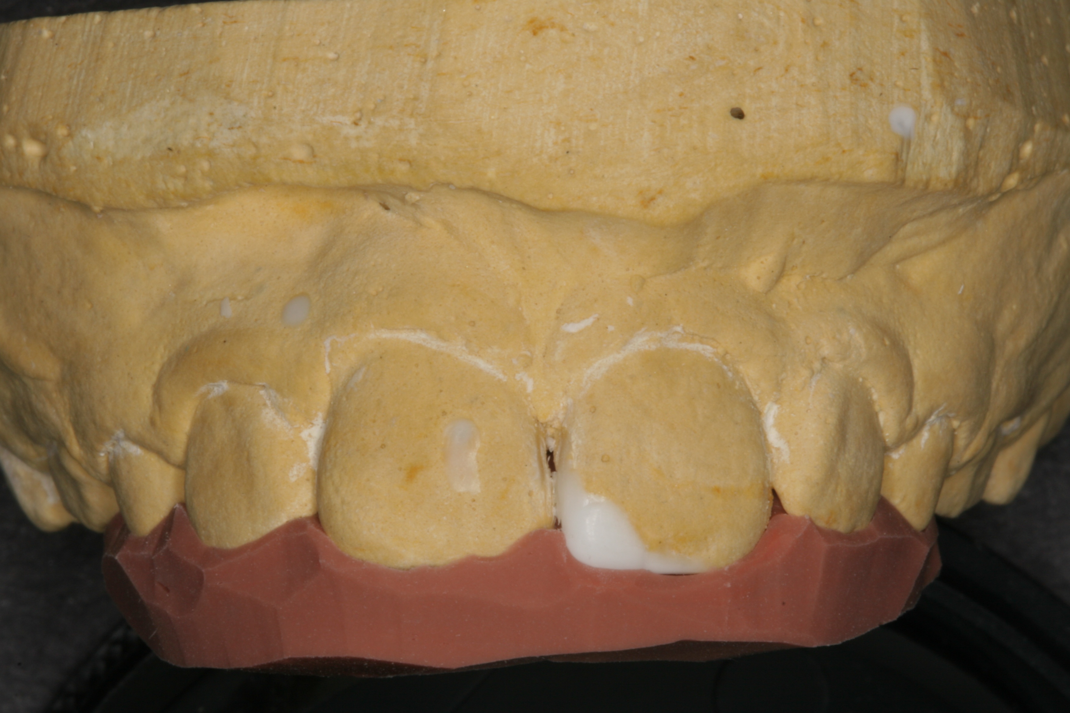 Mastering Anterior Composites: Tips from Dr. Fahl