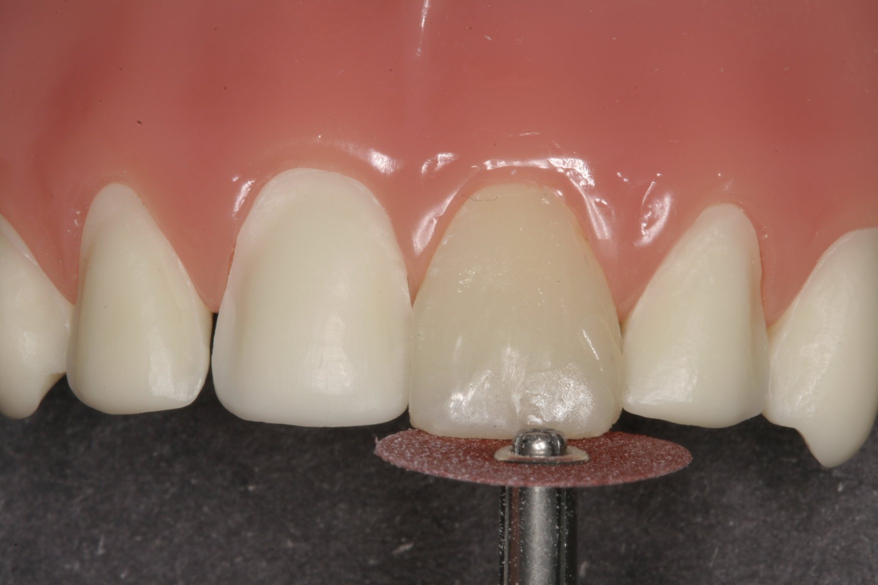 Mastering Anterior Composites: Tips from Dr. Fahl