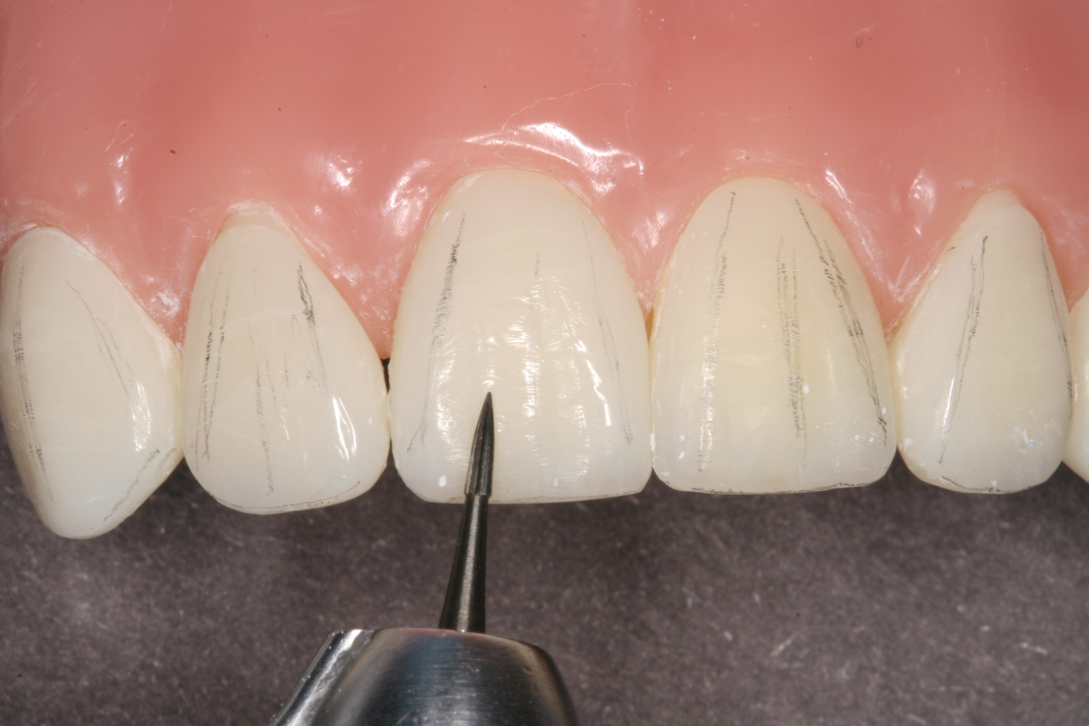 Mastering Anterior Composites: Tips from Dr. Fahl