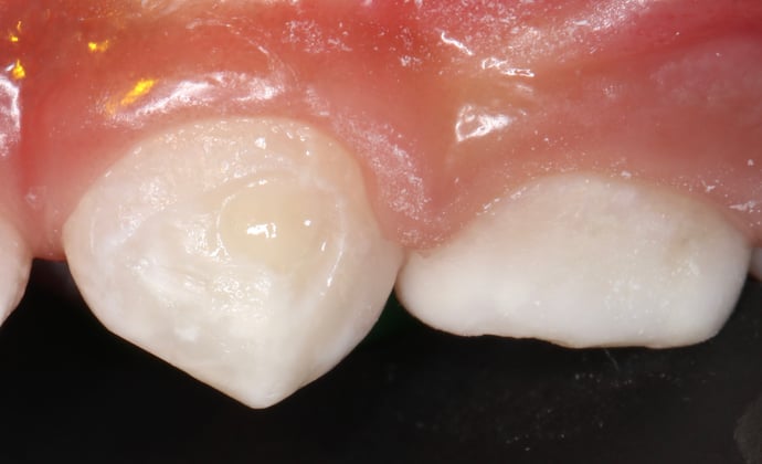 Top Composite Applications for Pediatric Dentistry