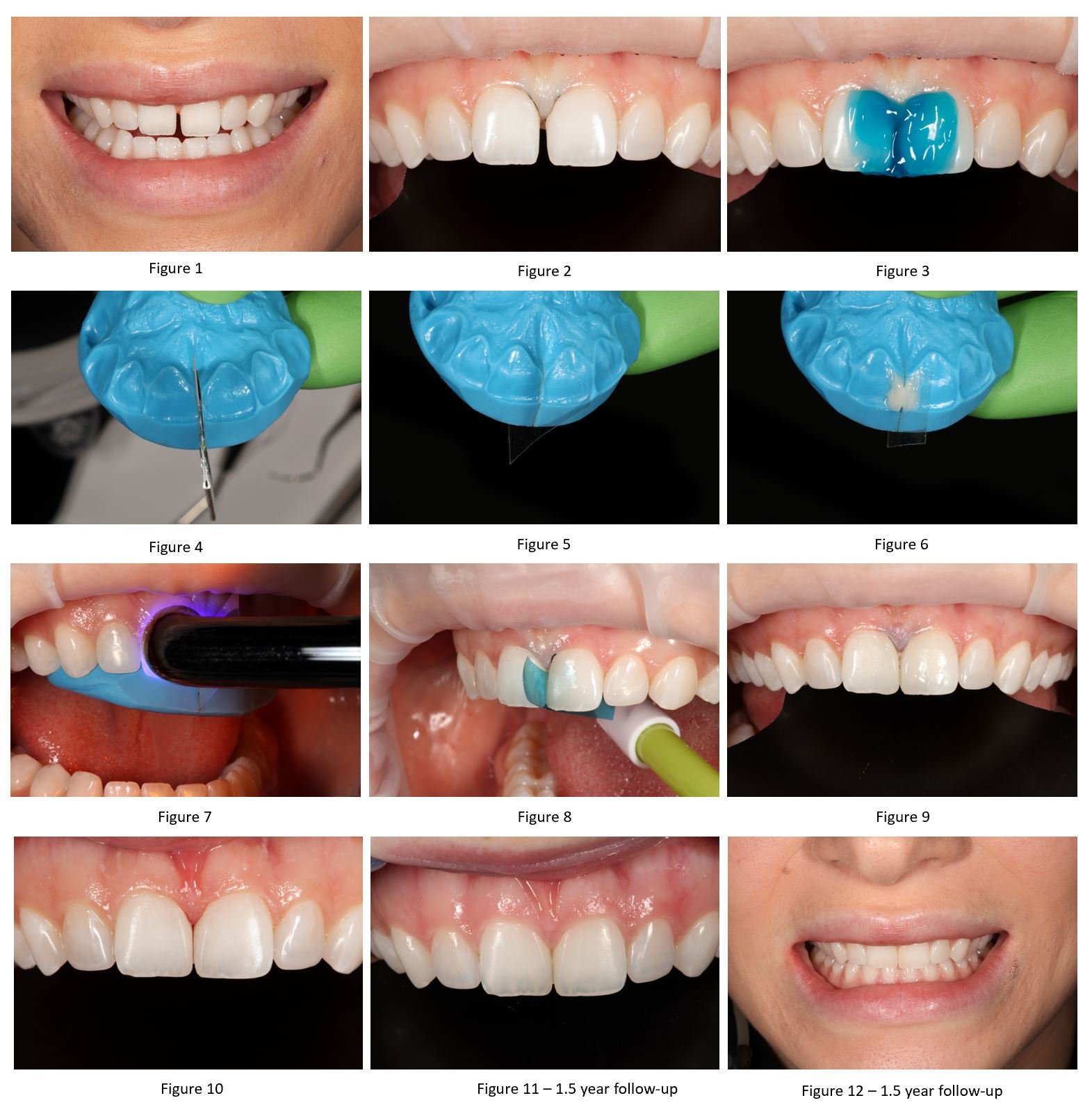 Silicone Putty Indexes: Composite Restoration Techniques I