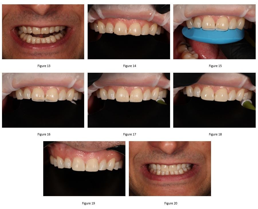 Seamless Results with Silicone Putty Indexes: Case Study II