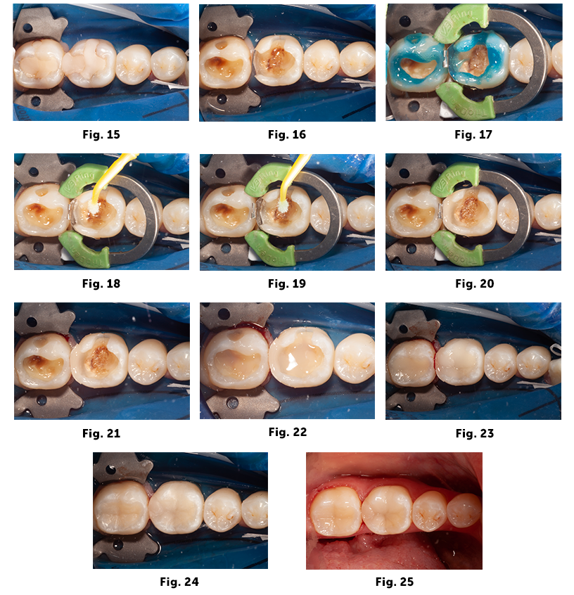Mastering Direct Composite Restorations with OMNICHROMA