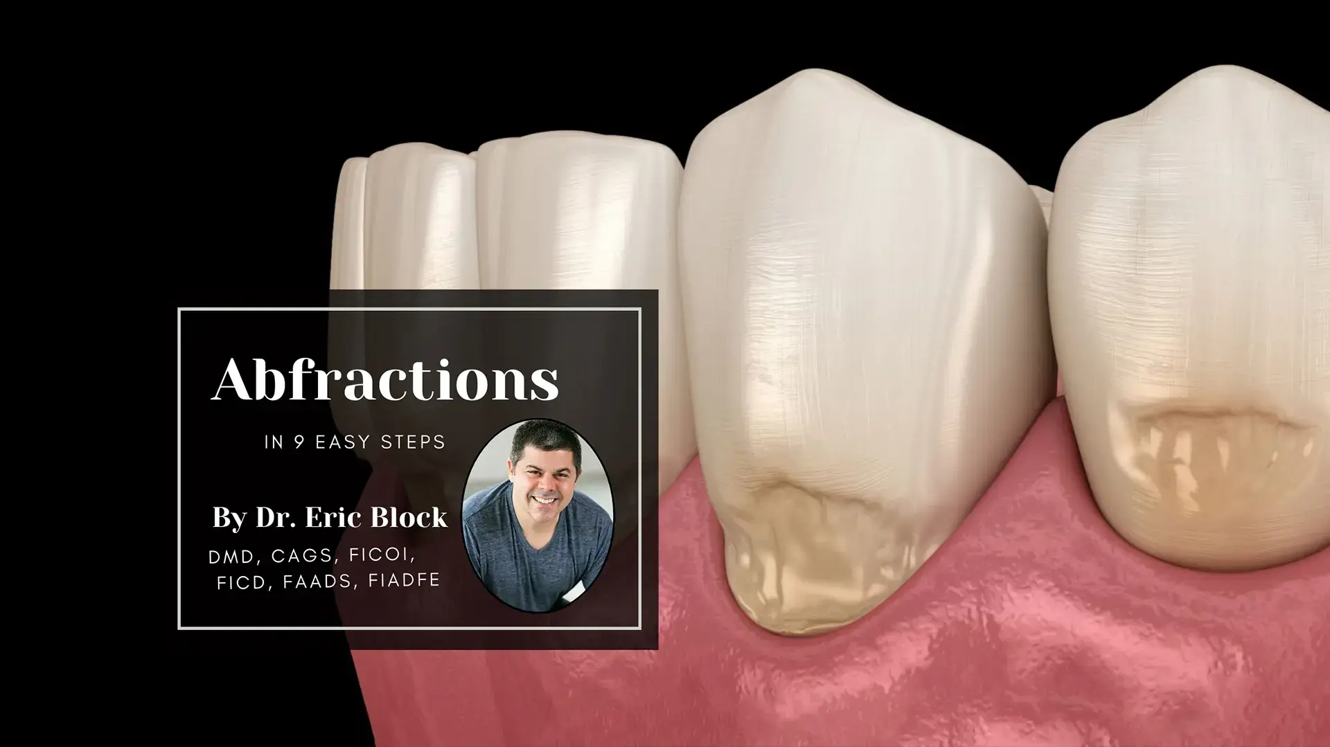 Abfractions Made Simple: 9 Steps to Transform Your Practice