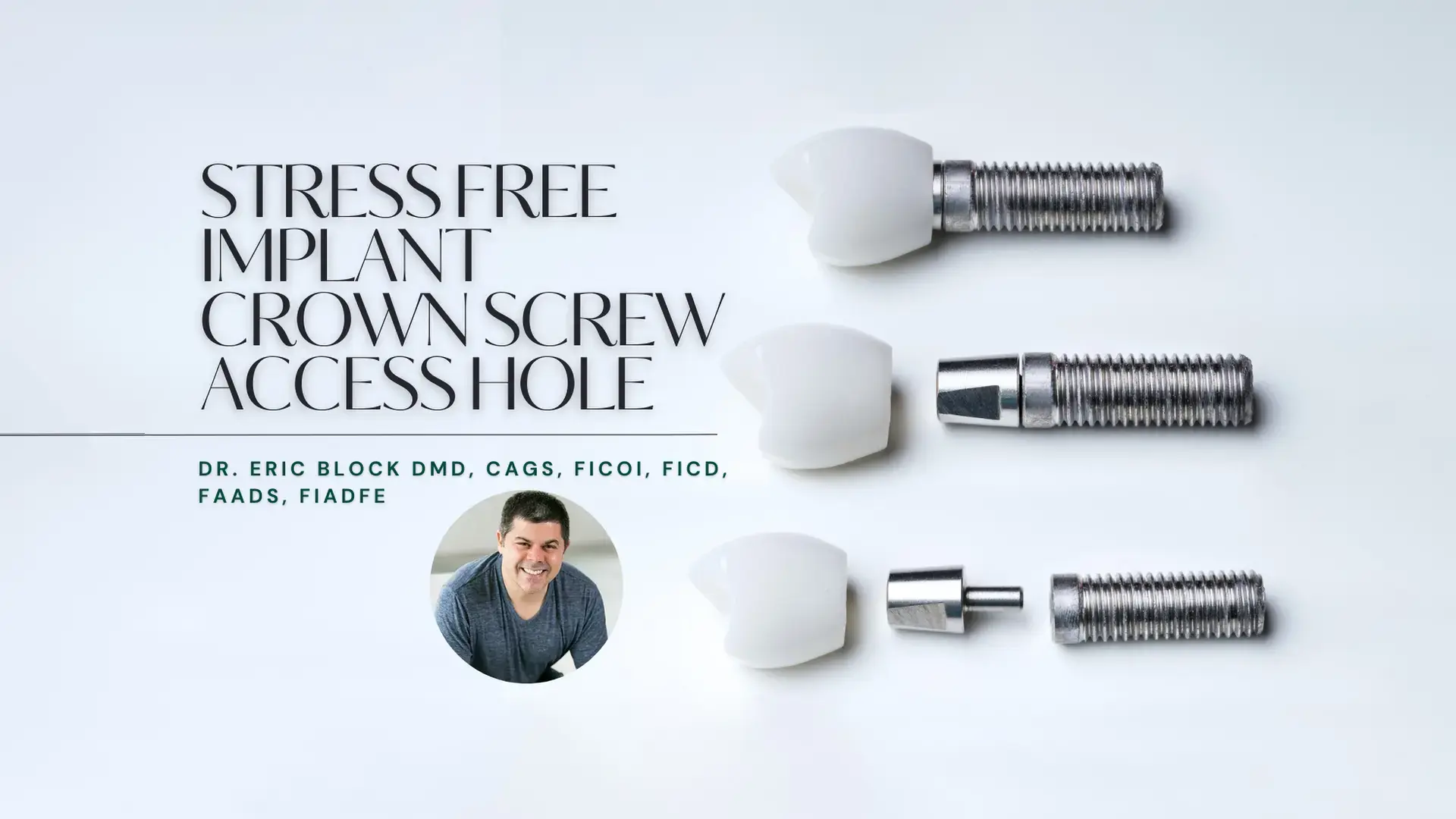 Stress-Free Implant Crown Solutions: My Evolving Journey